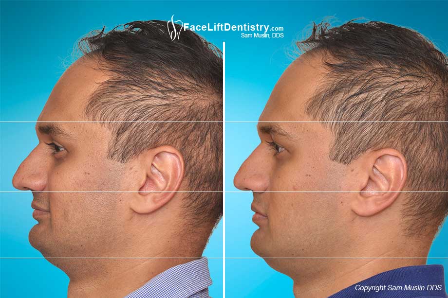 Overbite Correction in 8-Days Without Braces or Surgery Overbite Correction in 8-Days Without Braces or Surgery