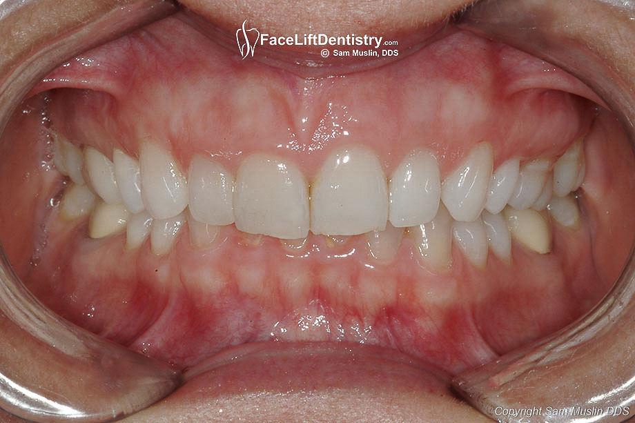 Overbite Correction Explained Adult Options And Treatment Overbite Correction Explained Adult Options And Treatment