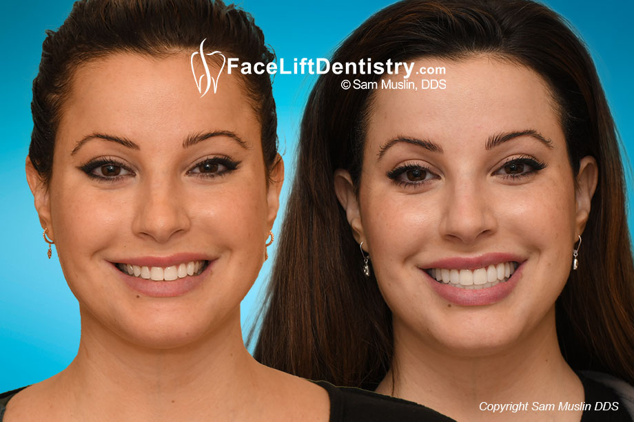 Face Lift Dentistry vs Neuromuscular TMJ Treatment: Patient's View Face Lift Dentistry vs Neuromuscular TMJ Treatment: Patient's View