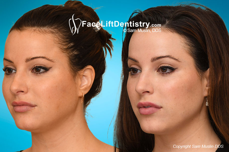 Face Lift Dentistry vs Neuromuscular TMJ Treatment: Patient's View Face Lift Dentistry vs Neuromuscular TMJ Treatment: Patient's View