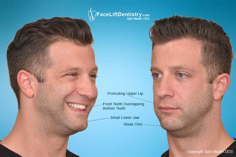 Receding Weak Chin And Small Jawline Quick Fix No Surgery Receding Weak Chin And Small Jawline Quick Fix No Surgery
